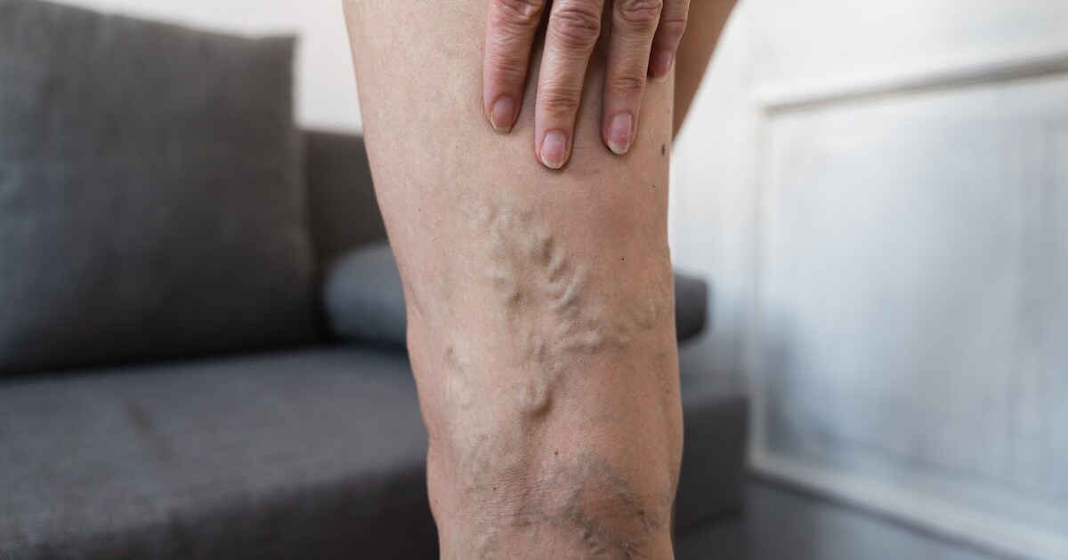 Dermatoloog: ‘Een zalf die spataderen doet verdwijnen? Dat is ...